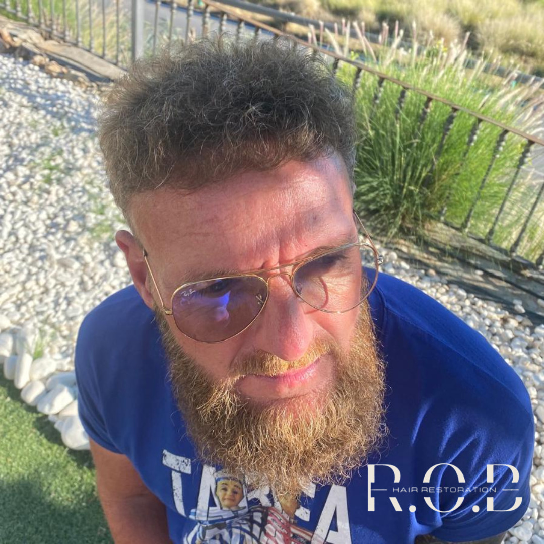 R.O.B Hair Restoration Website